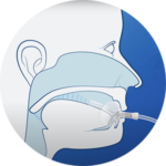 INAP - eine echte Alternative zur klassischen CPAP-Methode